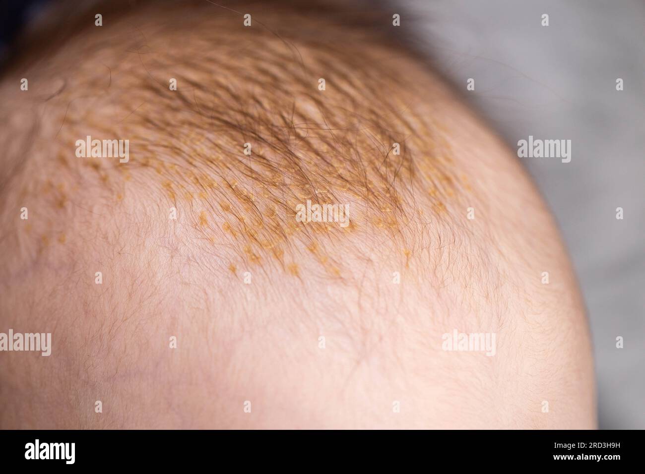 Seborrheic dermatitis on the skin on the head of a 6 month old baby ...