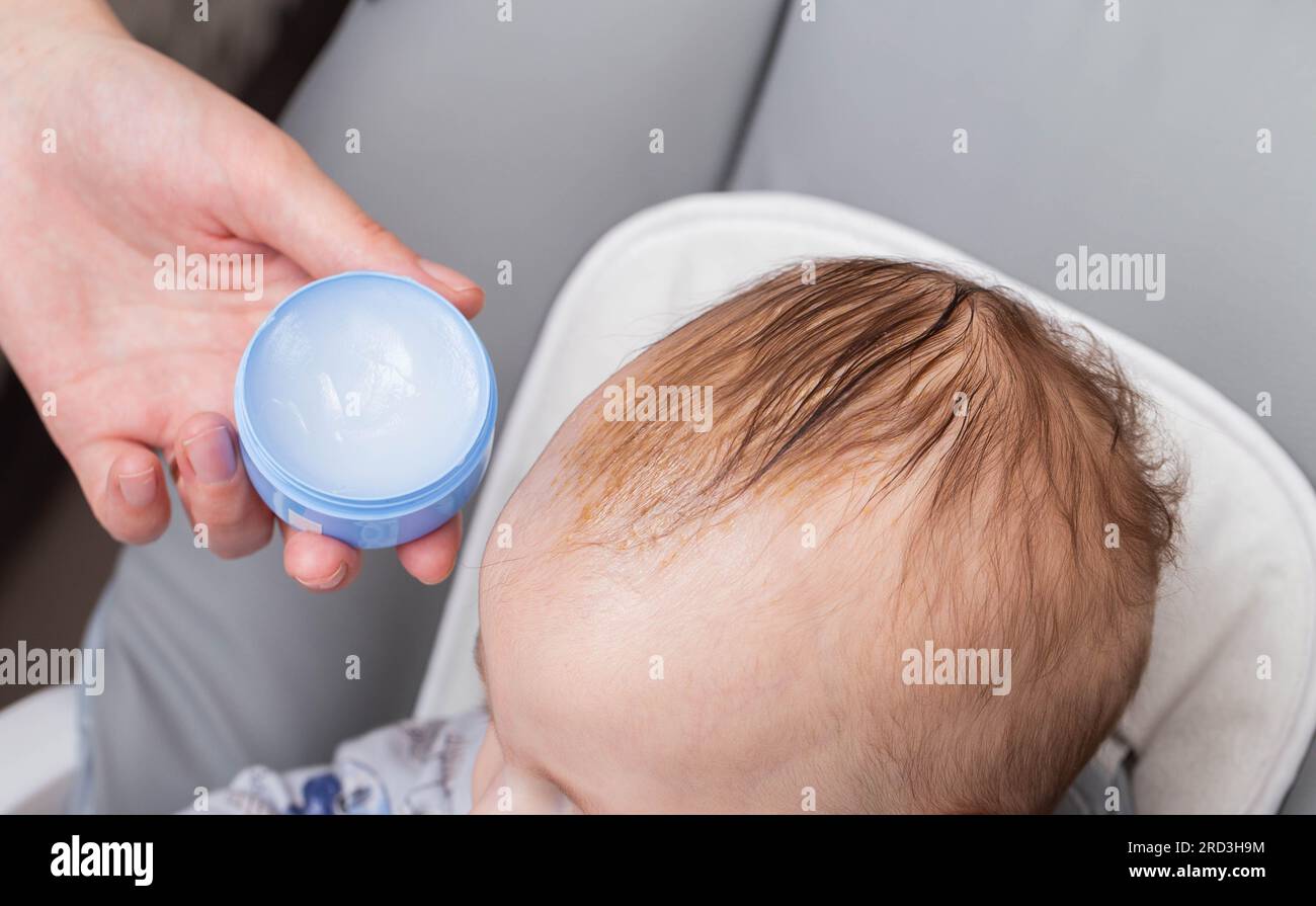 Smearing a seborrheic crust with baby oil on a child's head. Combing ...