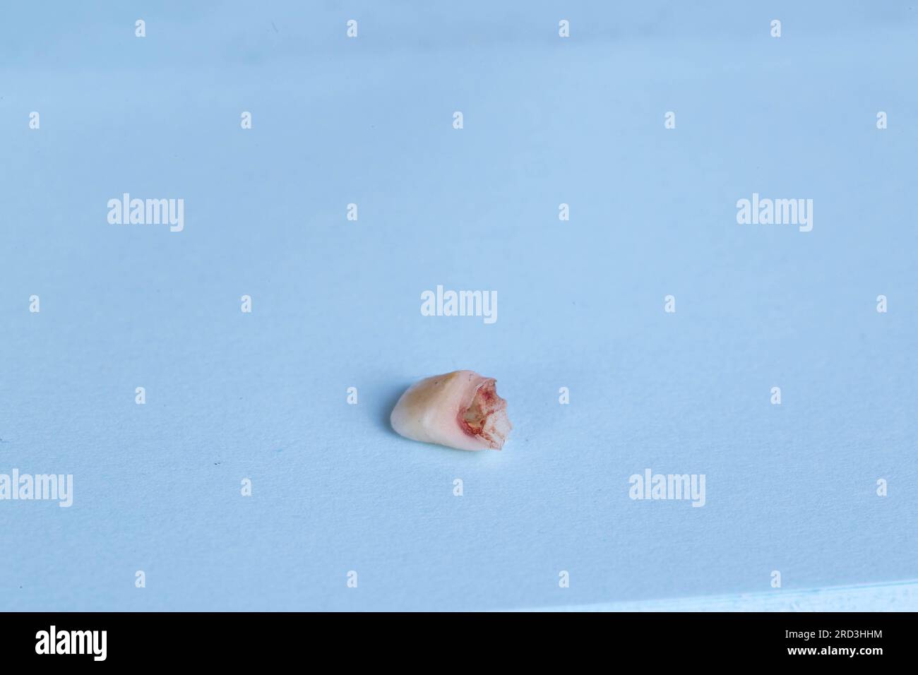 Children's milk tooth on a blue background. The concept of tooth ...