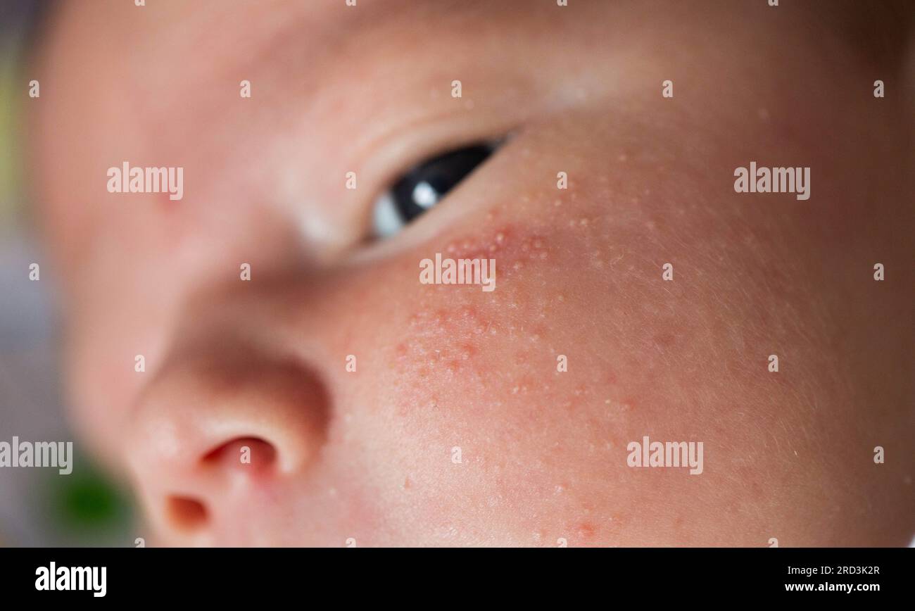 Rash on the face of a newborn baby. The process of formation of the ...