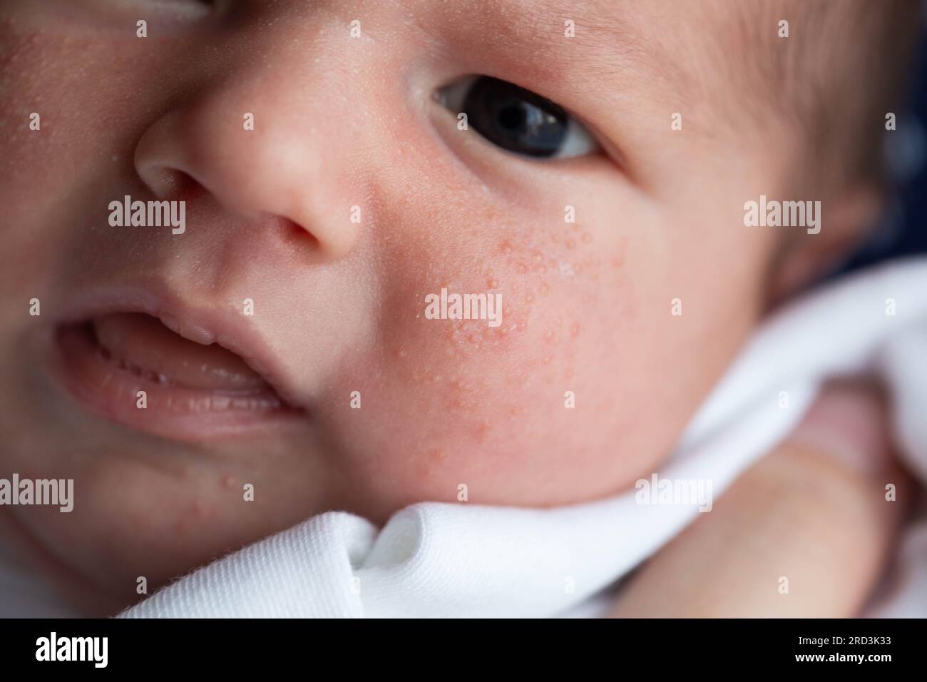Allergic pimples in a newborn on the face. Pathogenesis, acne of ...