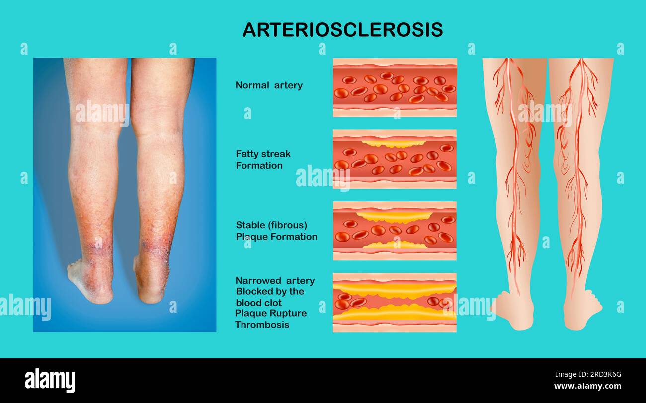 Human legs. Artery with blood cells desease. Concept of dry skin, old ...