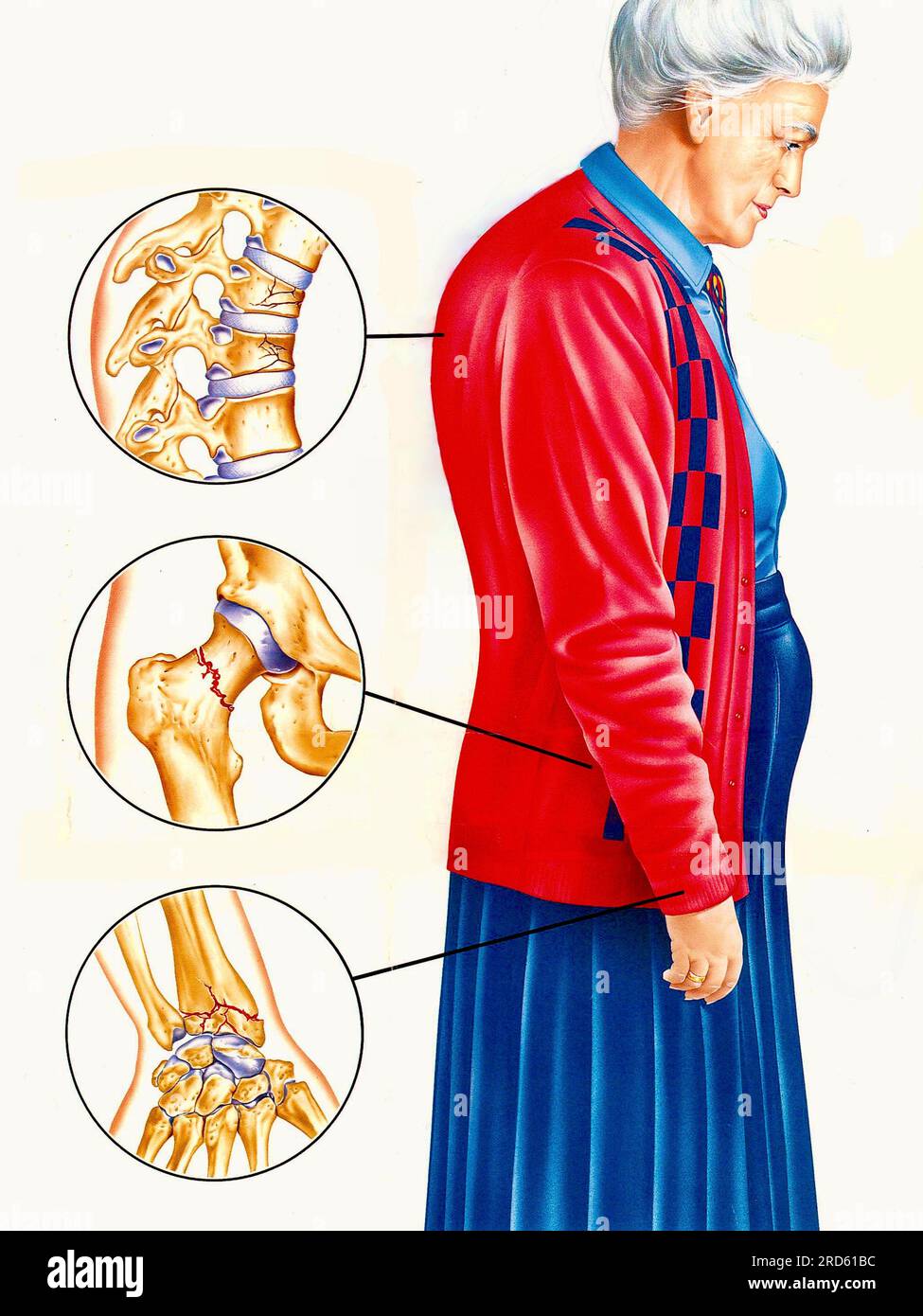 Illustration of an elderly woman stooped due to osteoporosis and common ...