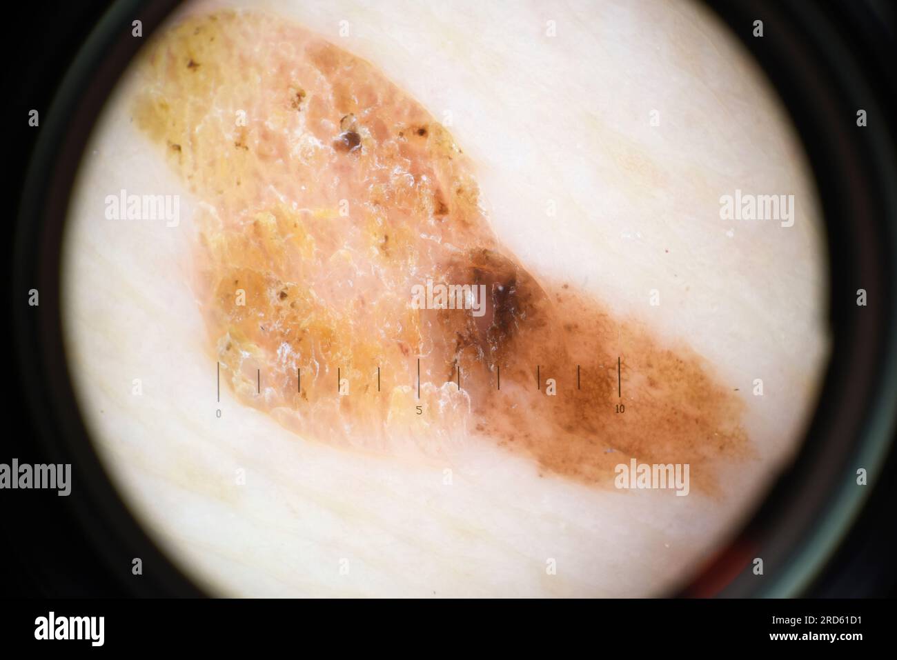 Seborrheic keratosis, dermoscopy Stock Photo - Alamy Seborrheic keratosis, dermoscopy Stock Photo - Alamy