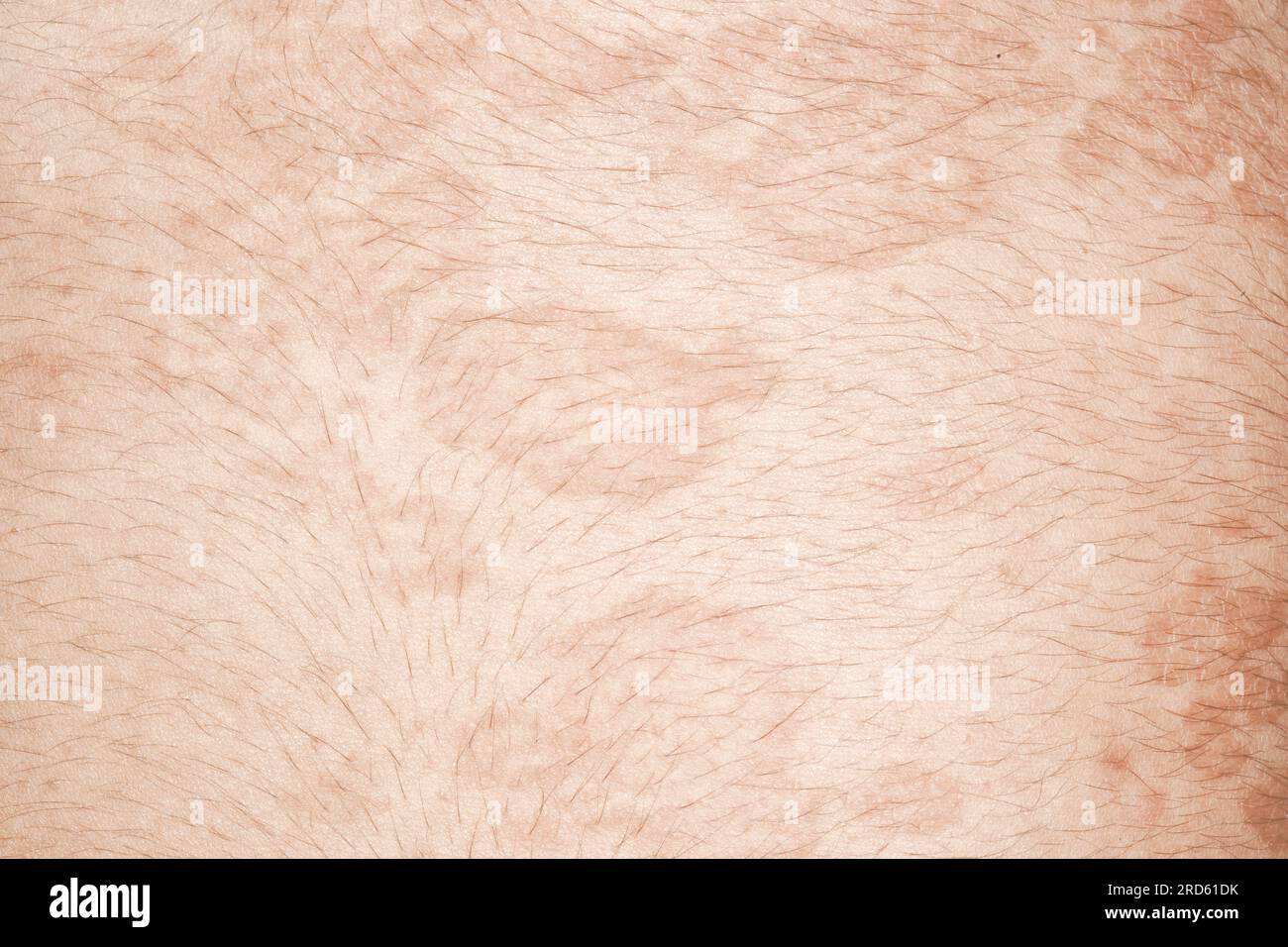 Pityriasis rosea rash Stock Photo - Alamy