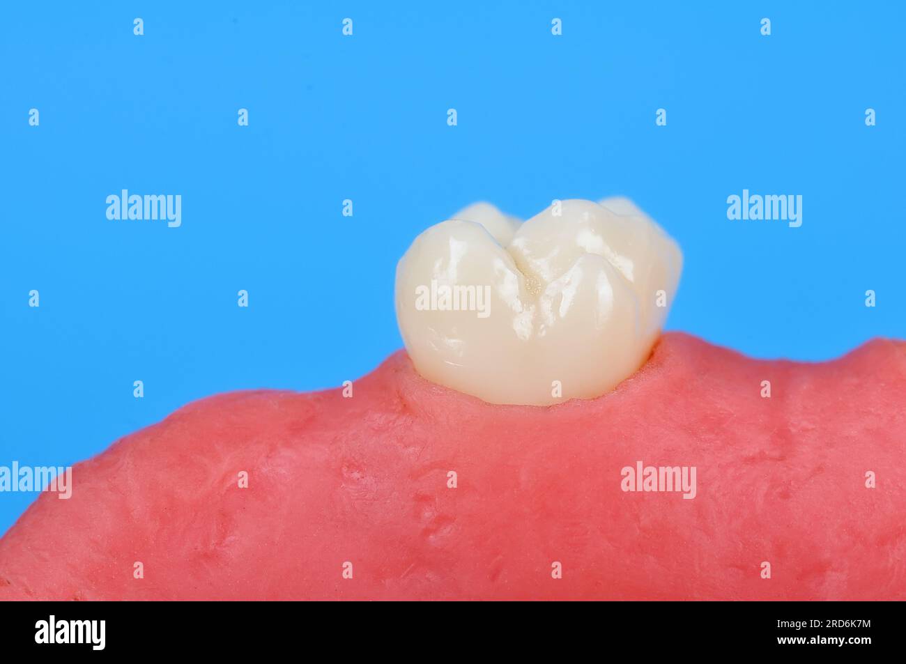 one tooth in the gum isolate in blue Stock Photo - Alamy
