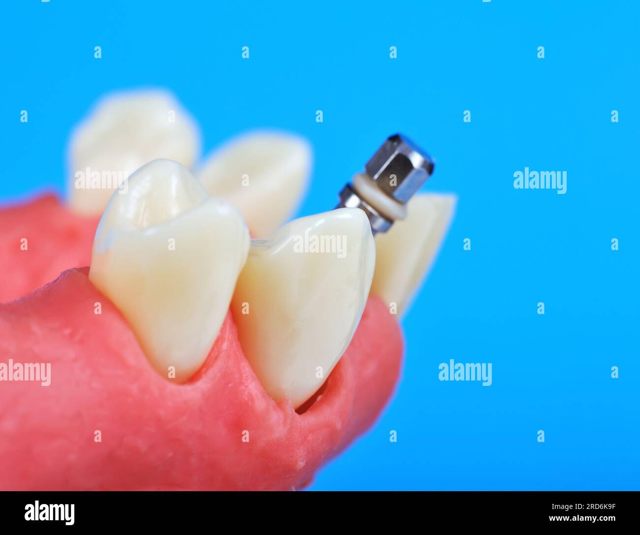 Dental titanium implant implanted in jaw bone Stock Photo - Alamy