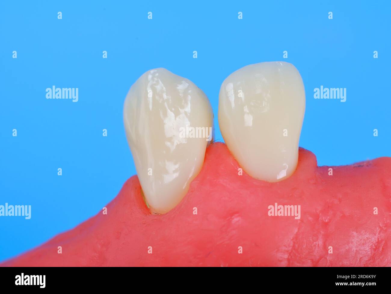two tooth in the gum isolate in blue Stock Photo - Alamy