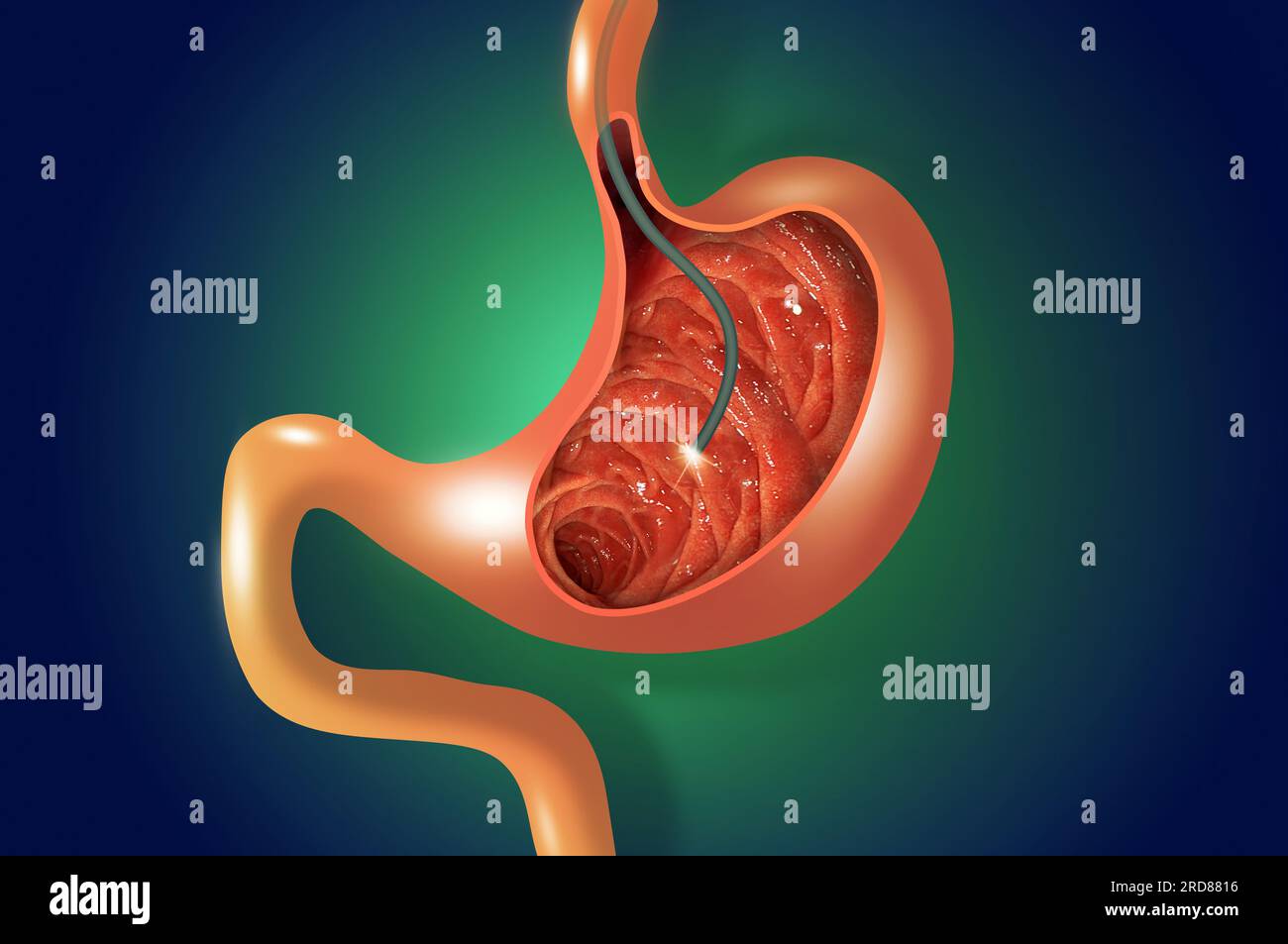 Stomach ulcer endoscopy hi-res stock photography and images - Alamy