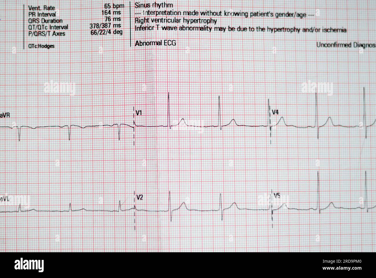 Ecg Electrocardiograph Paper That Shows Sinus Rhythm Abnormality Of Right Ventricular