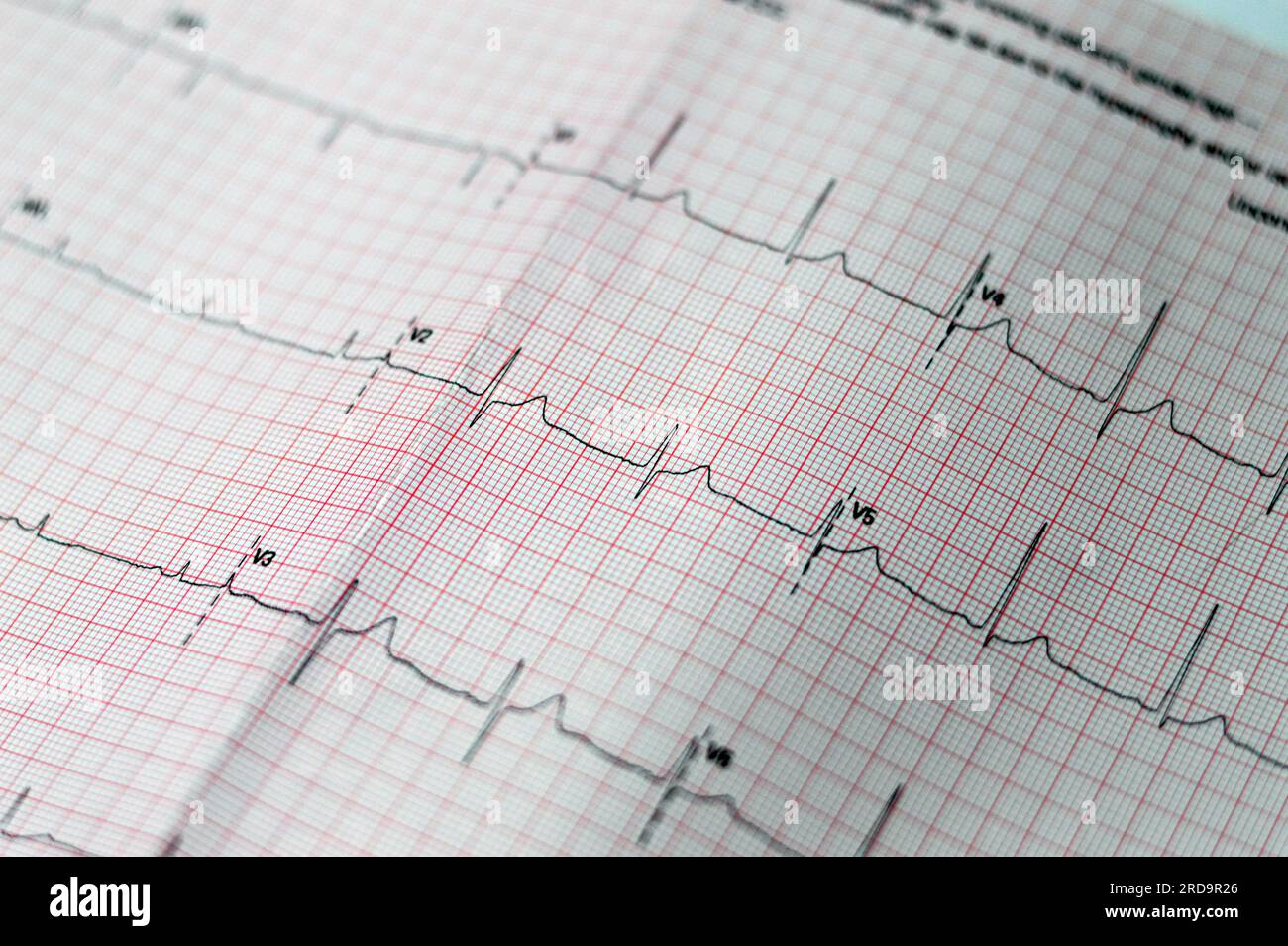 ECG ElectroCardioGraph paper that shows sinus rhythm abnormality of ...