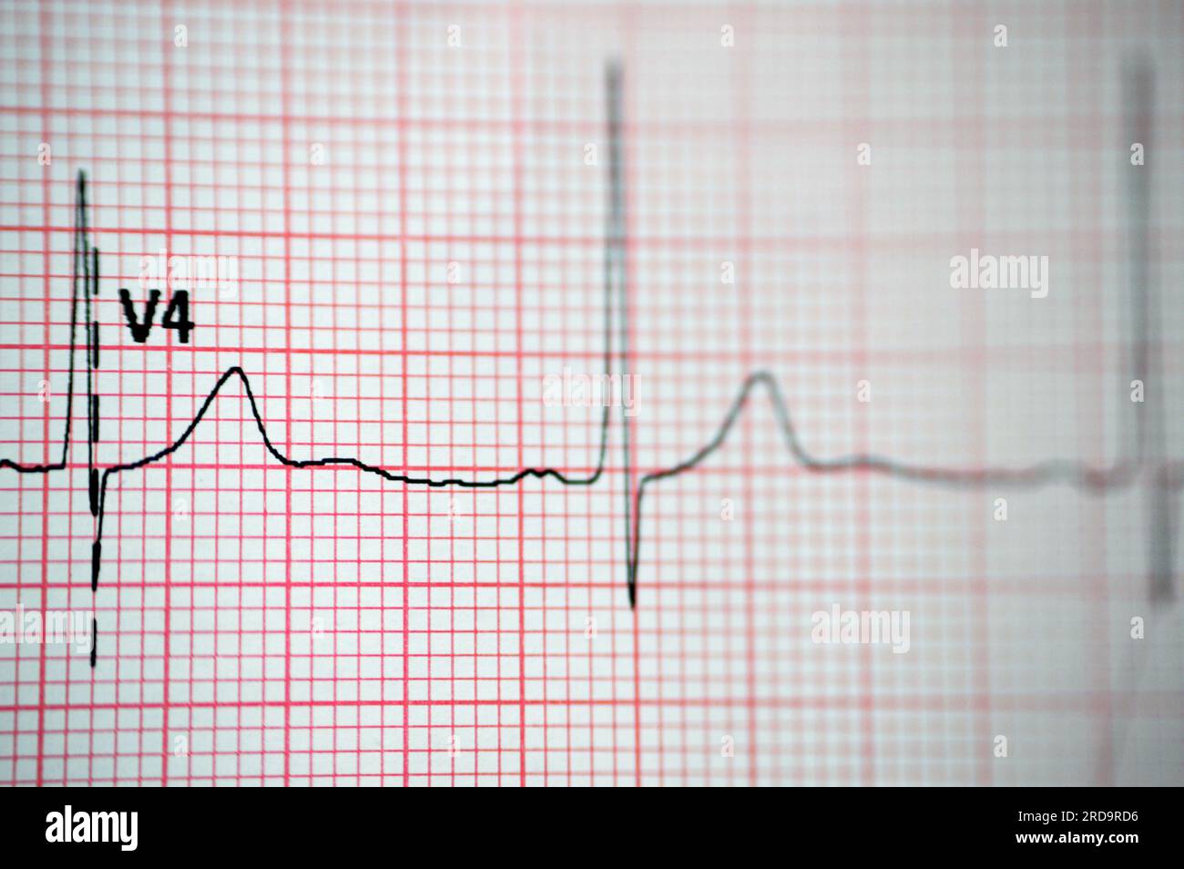 ECG ElectroCardioGraph paper that shows sinus rhythm abnormality of ...