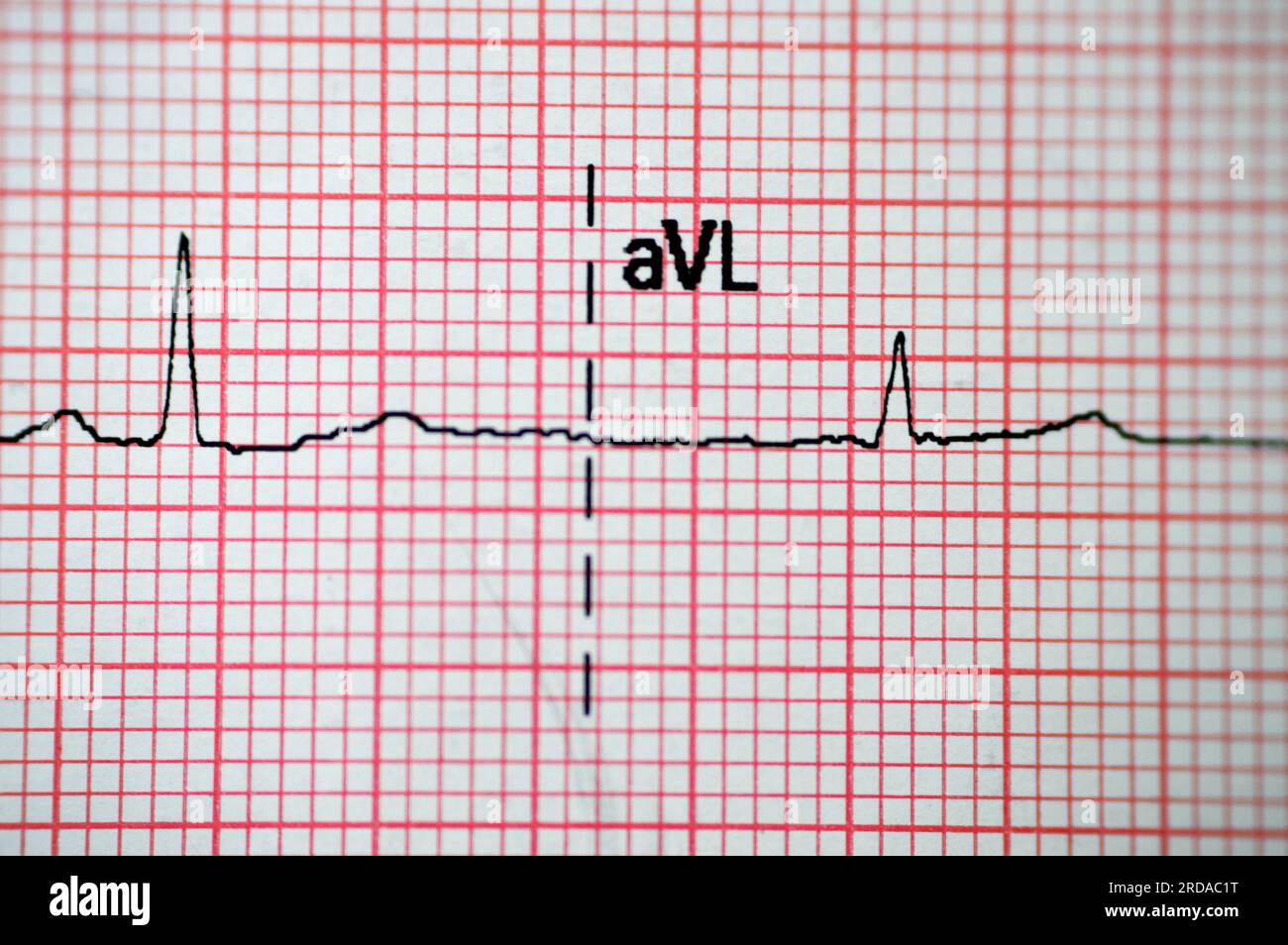 ECG ElectroCardioGraph paper that shows sinus rhythm abnormality of ...