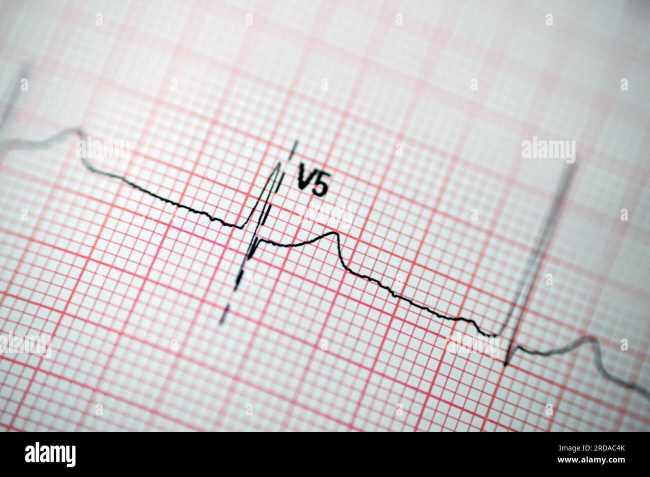 ECG ElectroCardioGraph paper that shows sinus rhythm abnormality of ...
