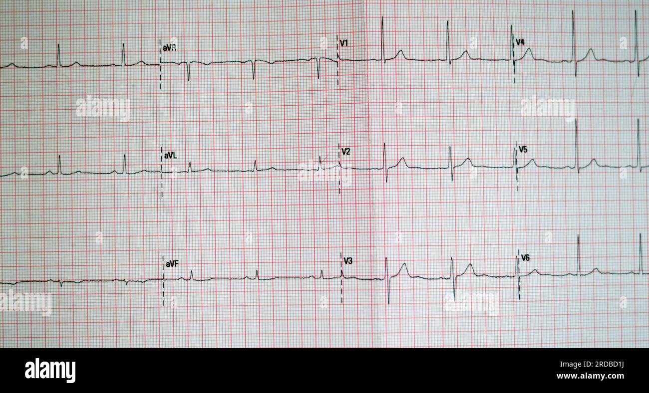 ECG ElectroCardioGraph paper that shows sinus rhythm abnormality of ...