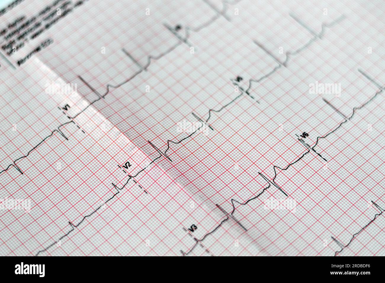 Electrocardiograph Paper at Eva Harpur blog
