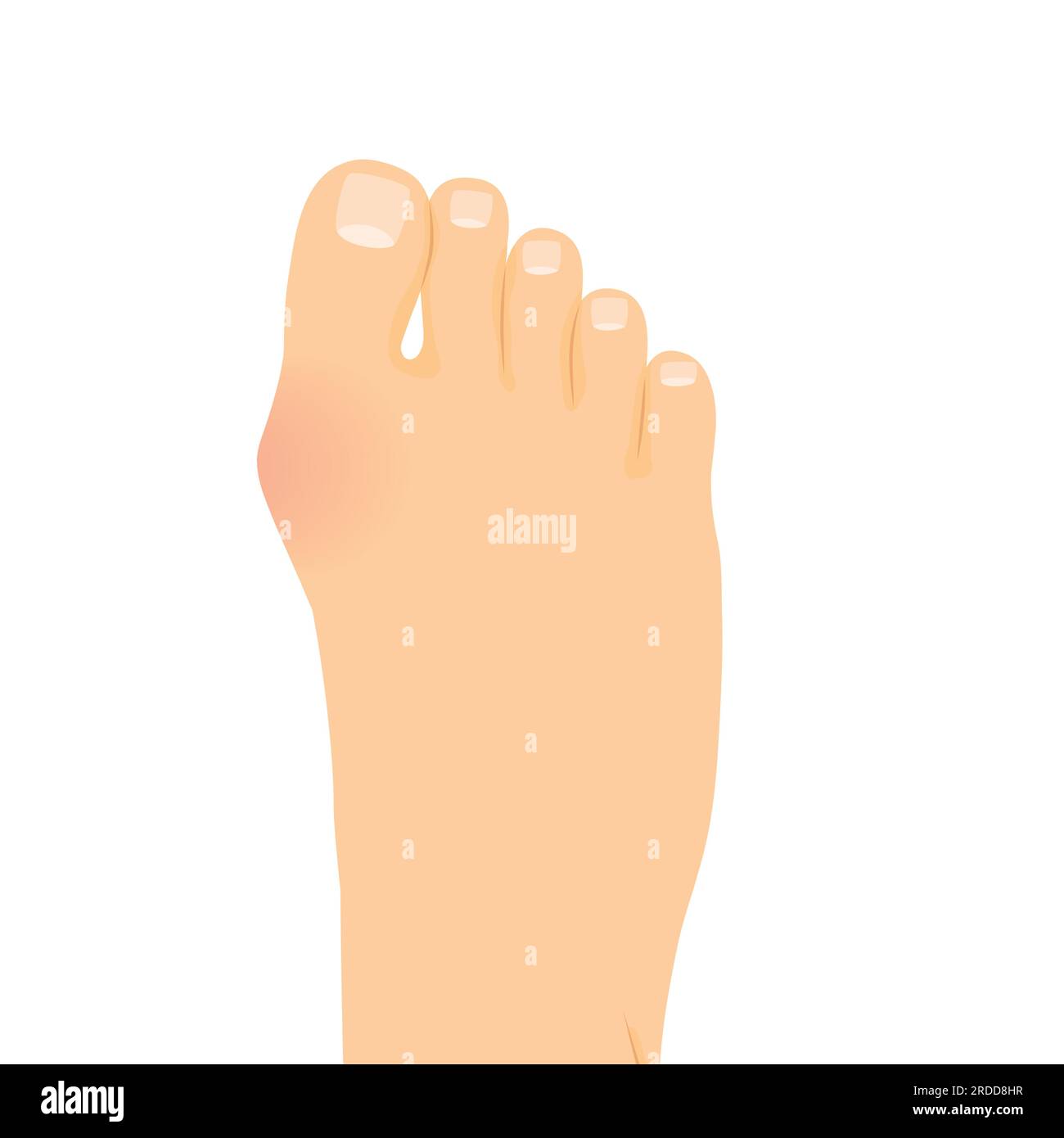 Hallux woman Stock Vector Images - Alamy