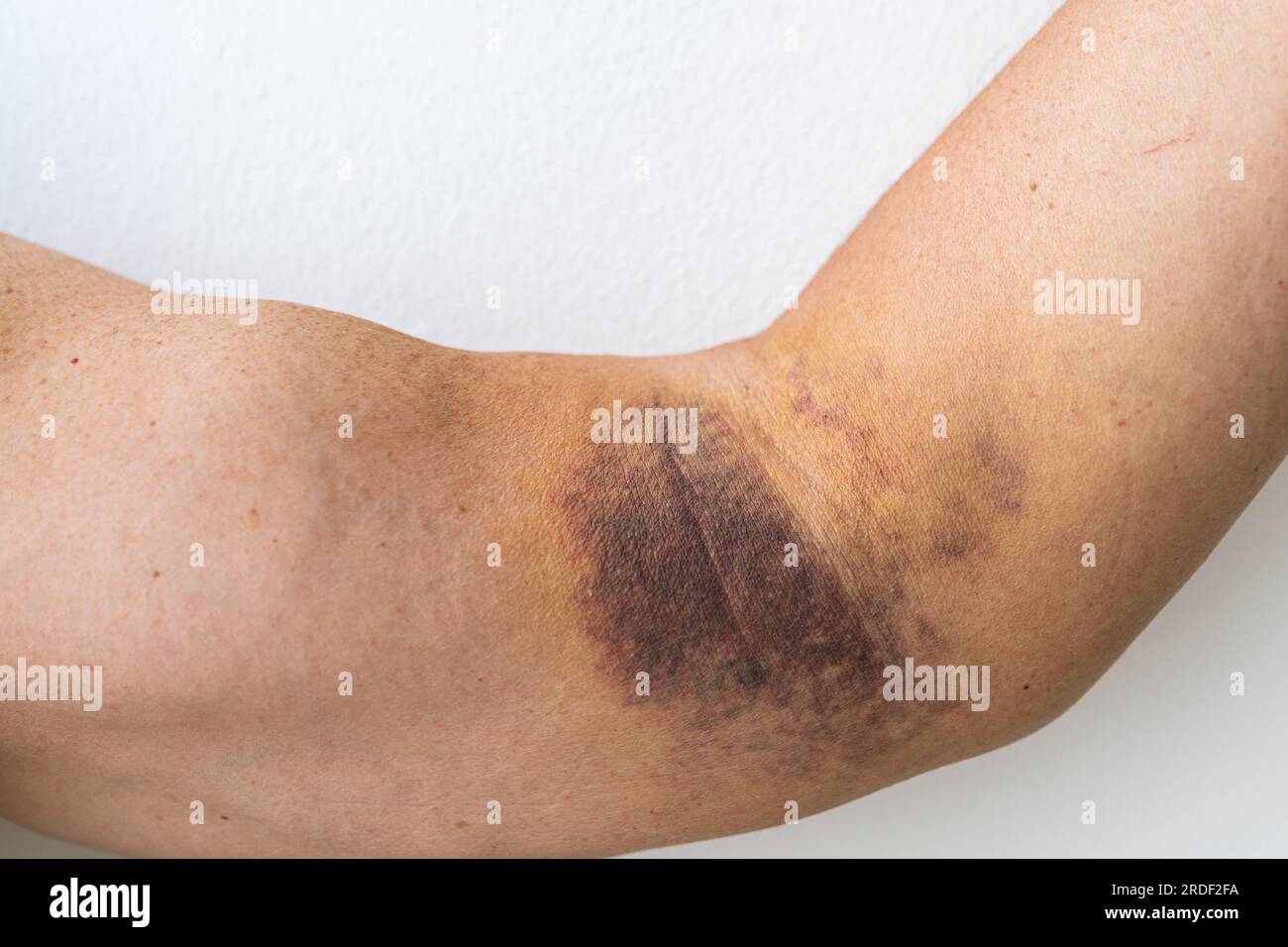 injury ligament arm bruise Stock Photo - Alamy