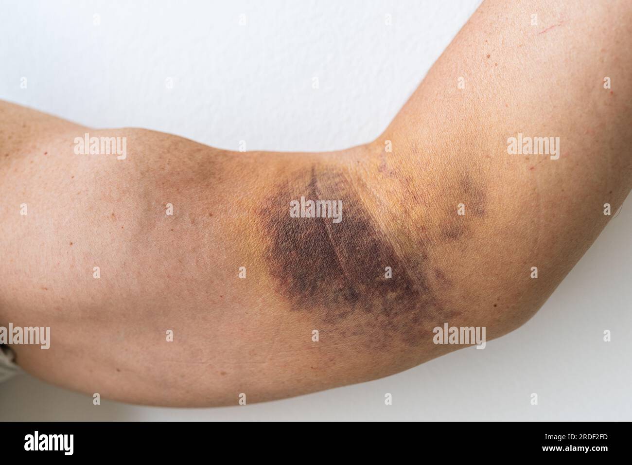 injury ligament arm bruise Stock Photo - Alamy