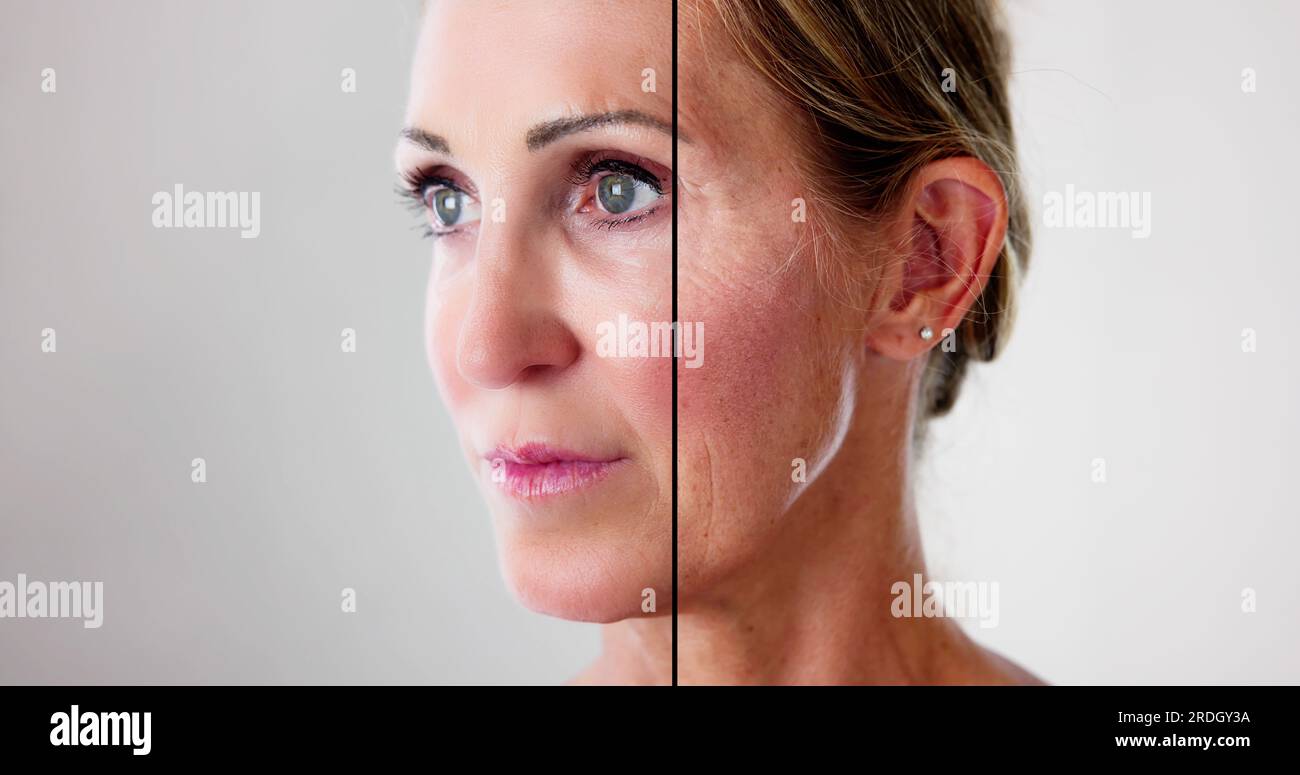 Woman Before And After Face Lift Therapy Injection Stock Photo - Alamy