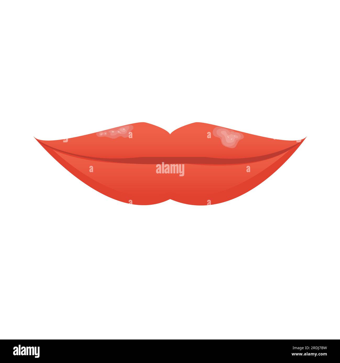 Cold sore, illustration Stock Photo - Alamy