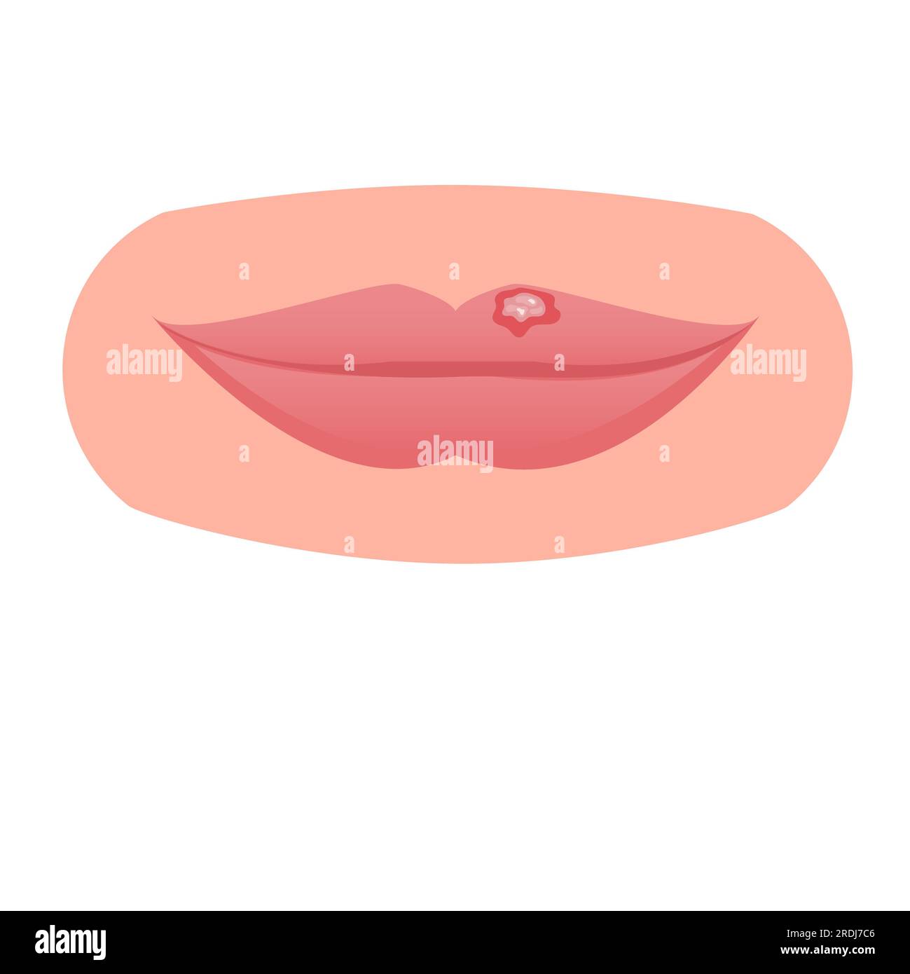 Cold sore, illustration Stock Photo - Alamy