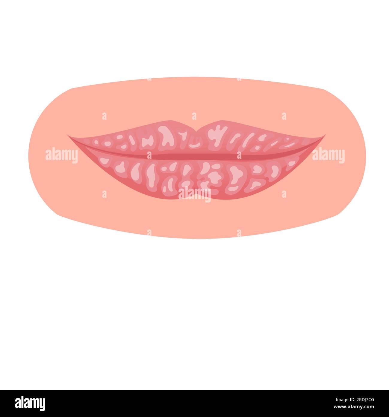 Extremely Dry Lips Is A Sign Of At Rita Davis Blog