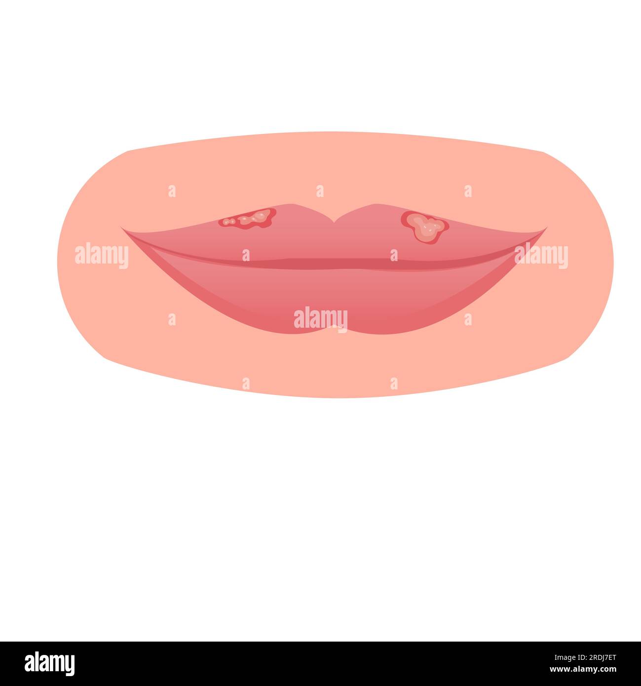 Cold sore, illustration Stock Photo - Alamy