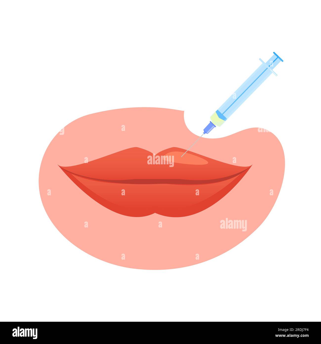 Lip augmentation, illustration Stock Photo - Alamy