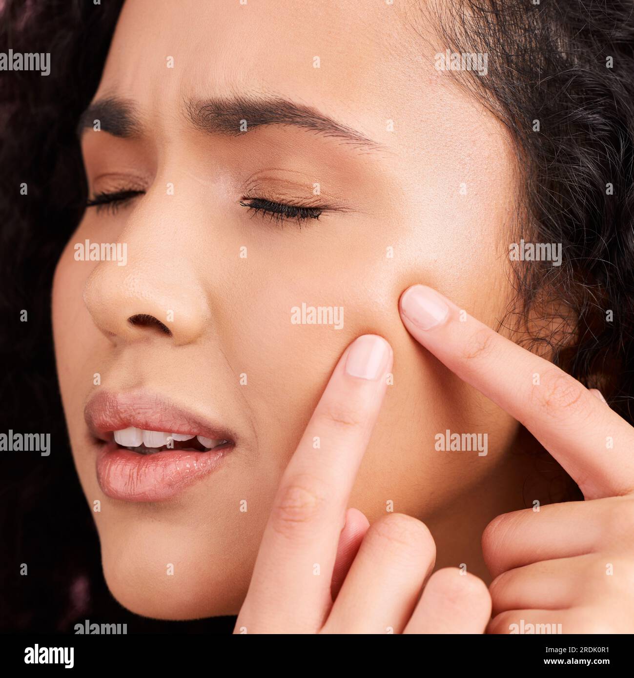 Acne, woman and skincare with squeeze pimple for problem with ...