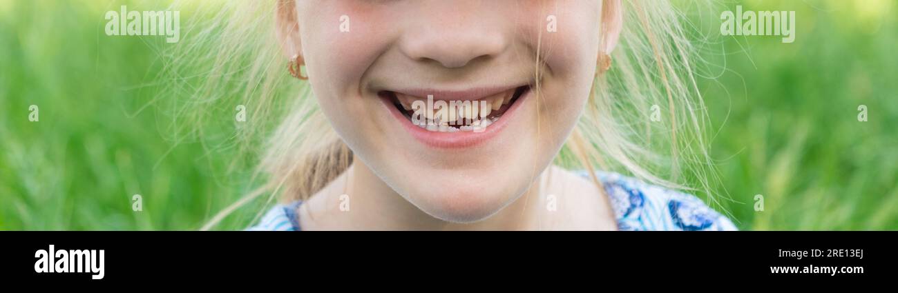 Smile and teeth of a 7-year-old girl close-up. Paediatric dentistry ...