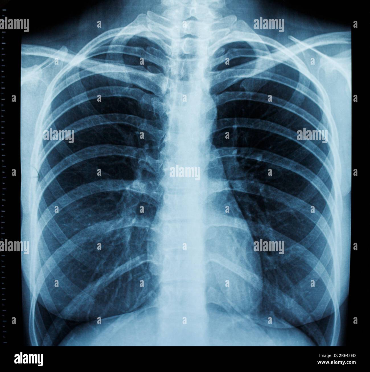 Fluorography of the human chest, frontal x-ray Stock Photo - Alamy