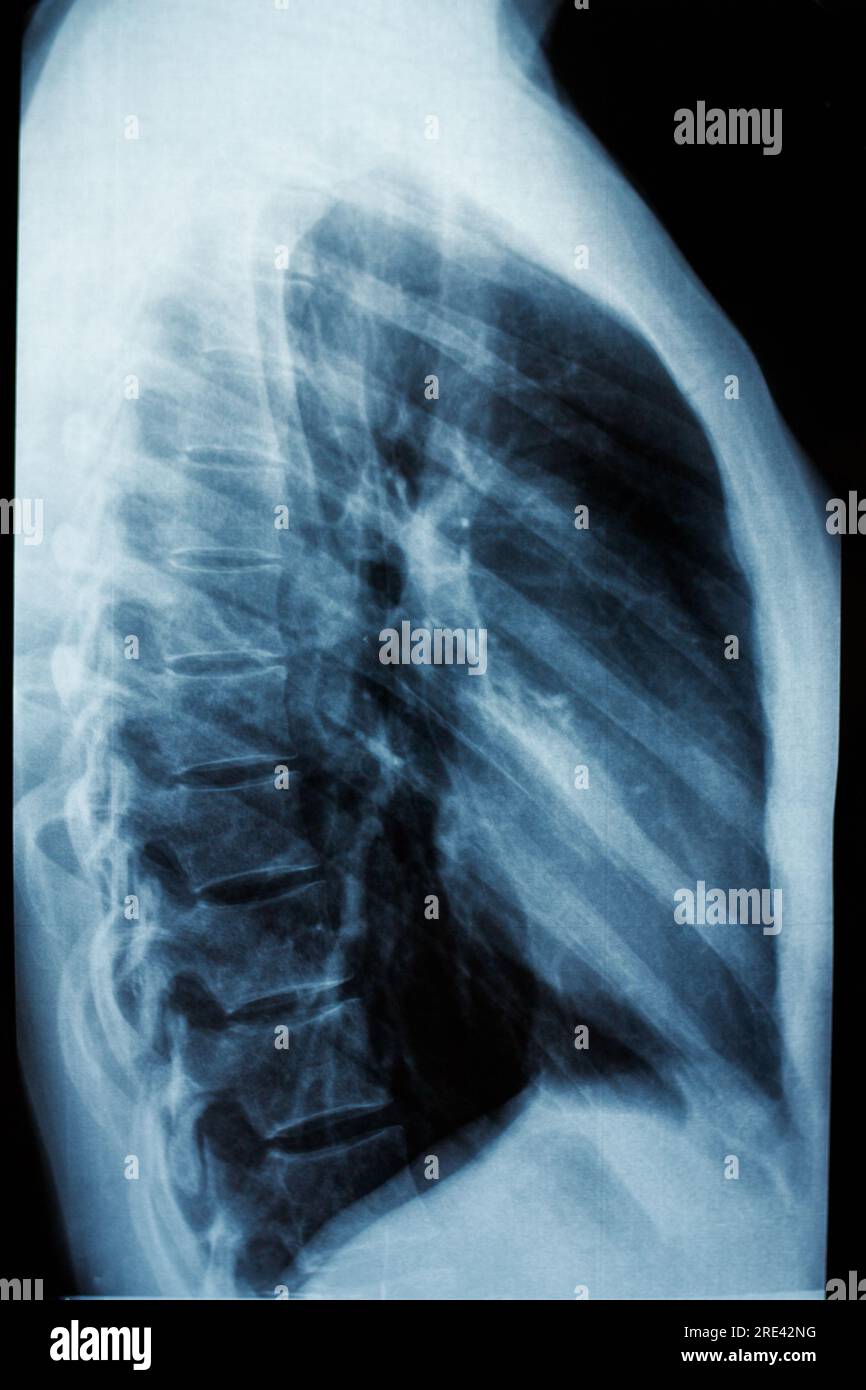 Diagnosis with x-ray. Fluorography of the human chest, side view Stock ...