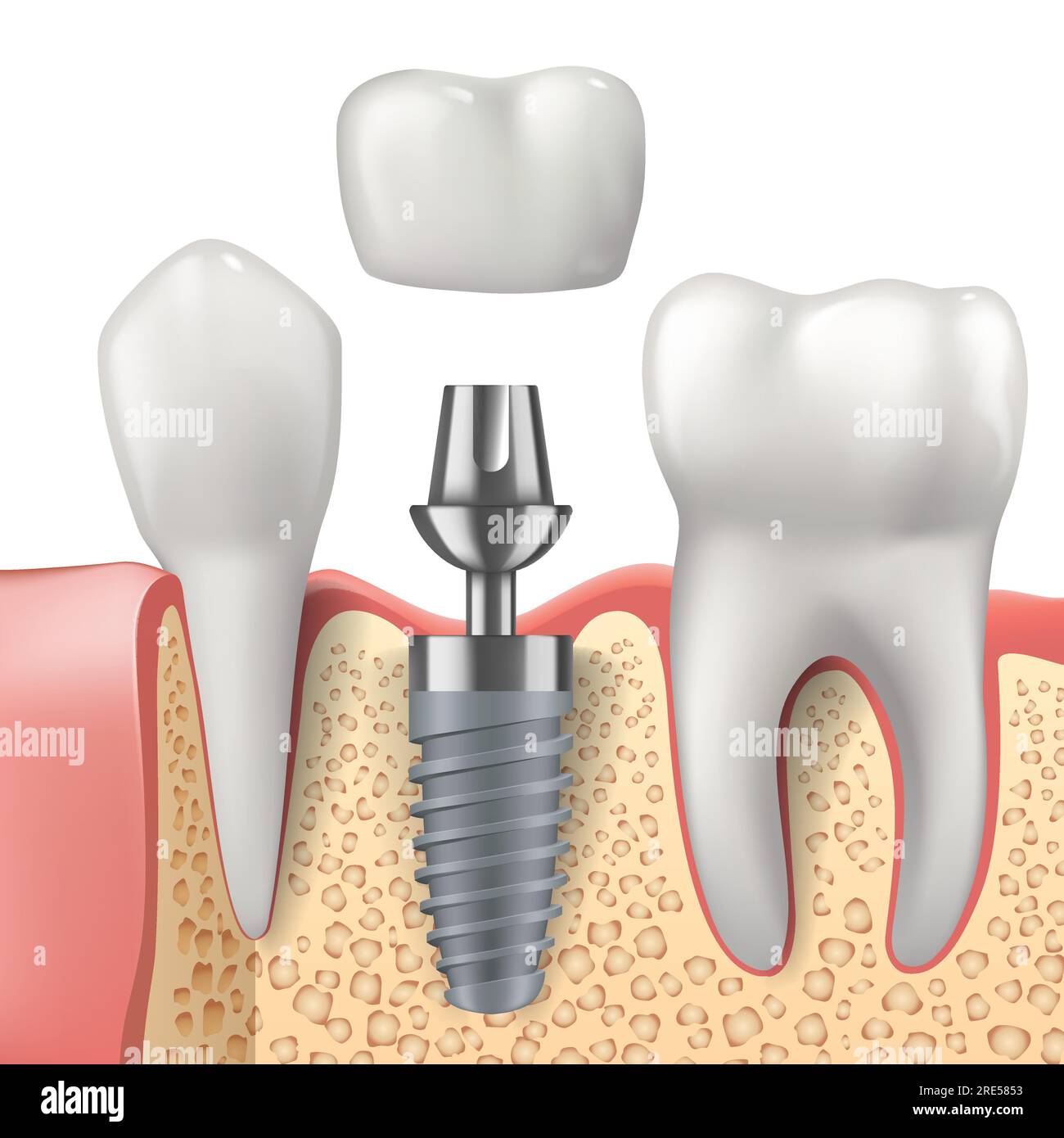 Teeth and dental implant realistic vector design of dentistry. 3d tooth ...
