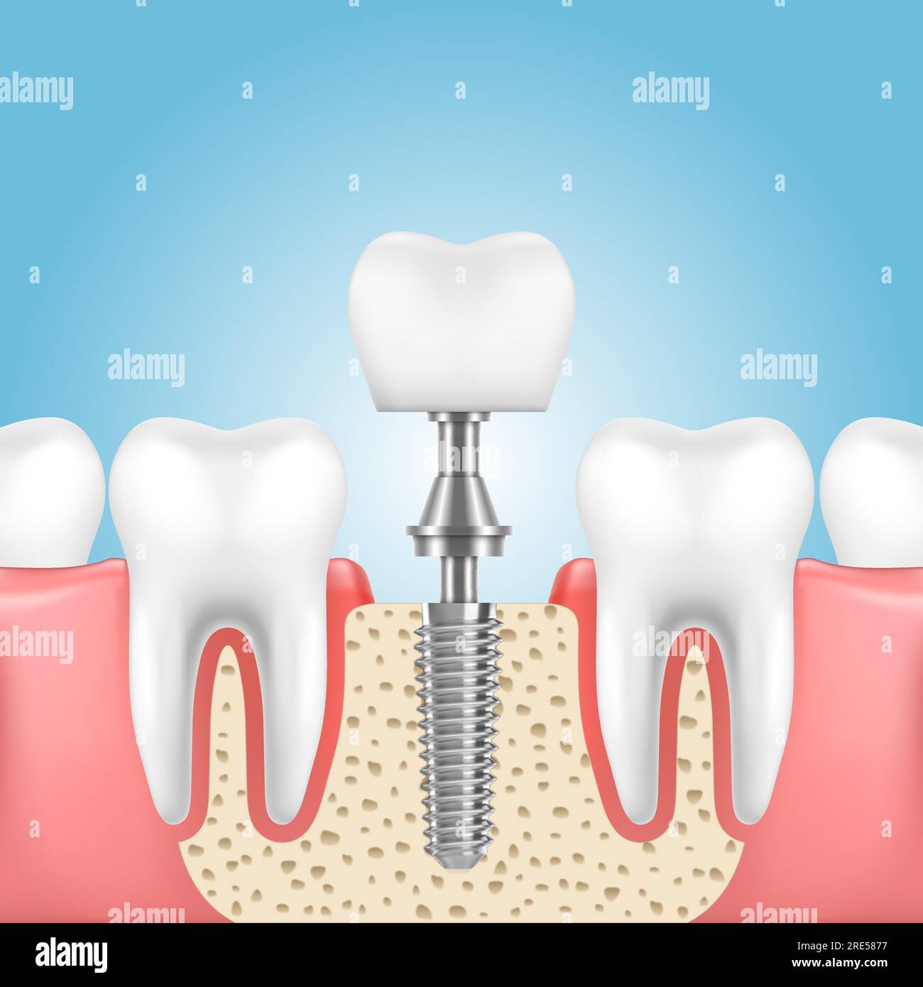 Tooth dental implant, vector dentistry, dentist and denture ...