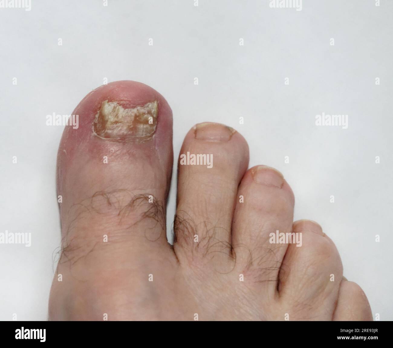 Fungal nail hi-res stock photography and images - Alamy
