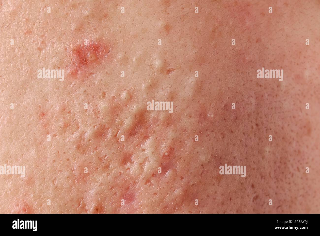 Young person with acne problem, closeup view of skin Stock Photo - Alamy