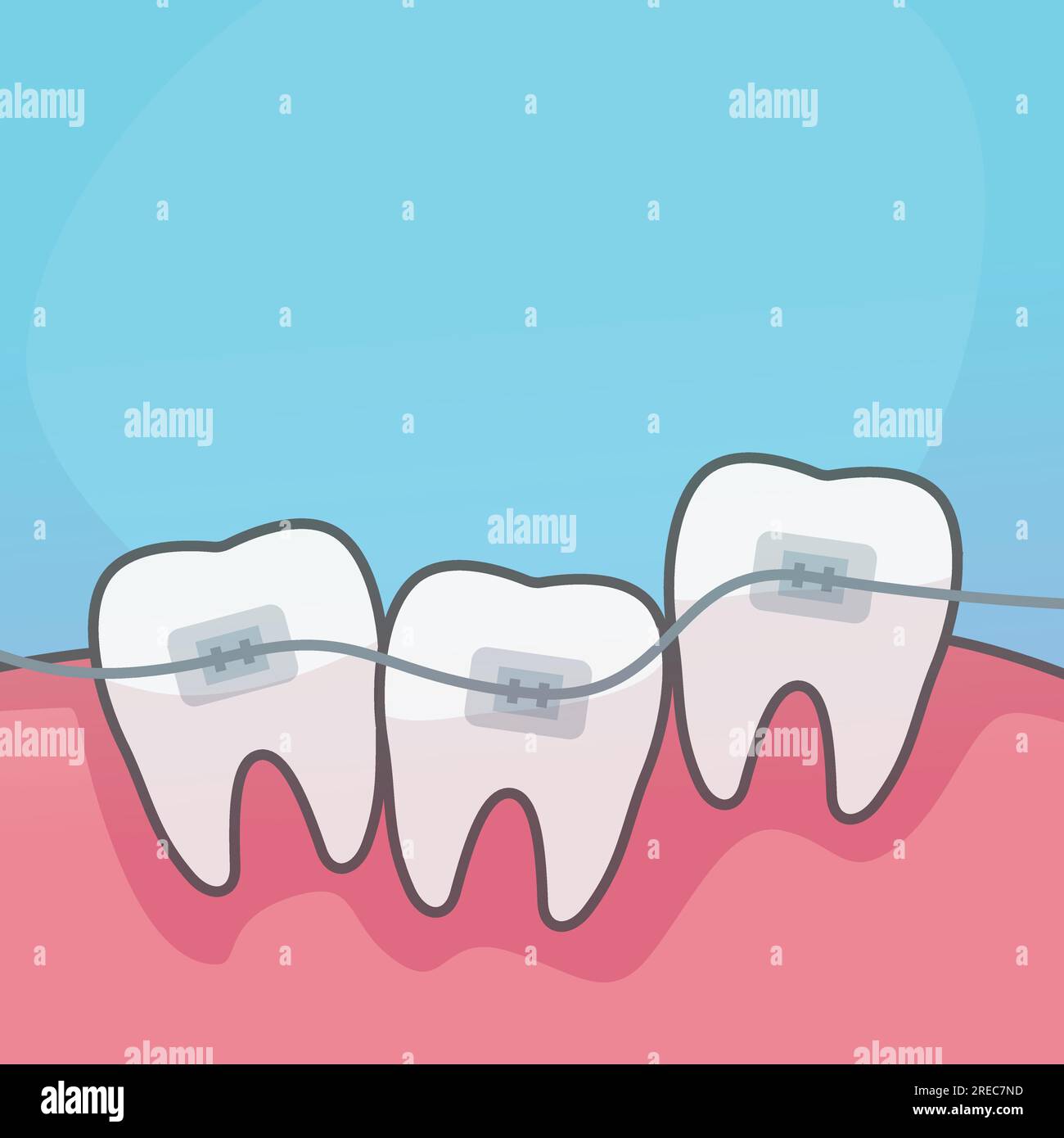 a dental braces fixing teeth flat design Stock Vector Image & Art - Alamy