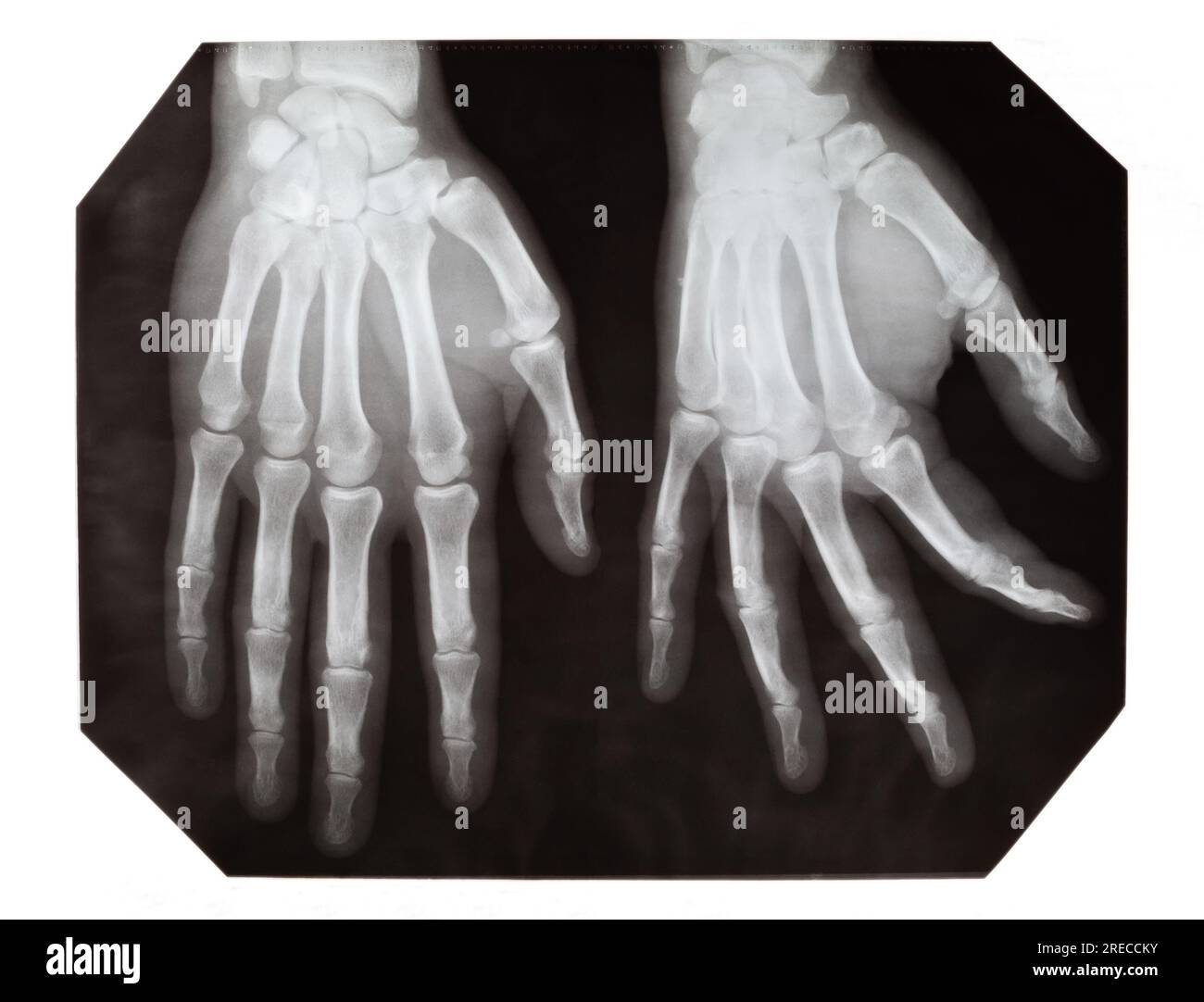 X-ray images of a hand with a fracture in different projections, on a ...