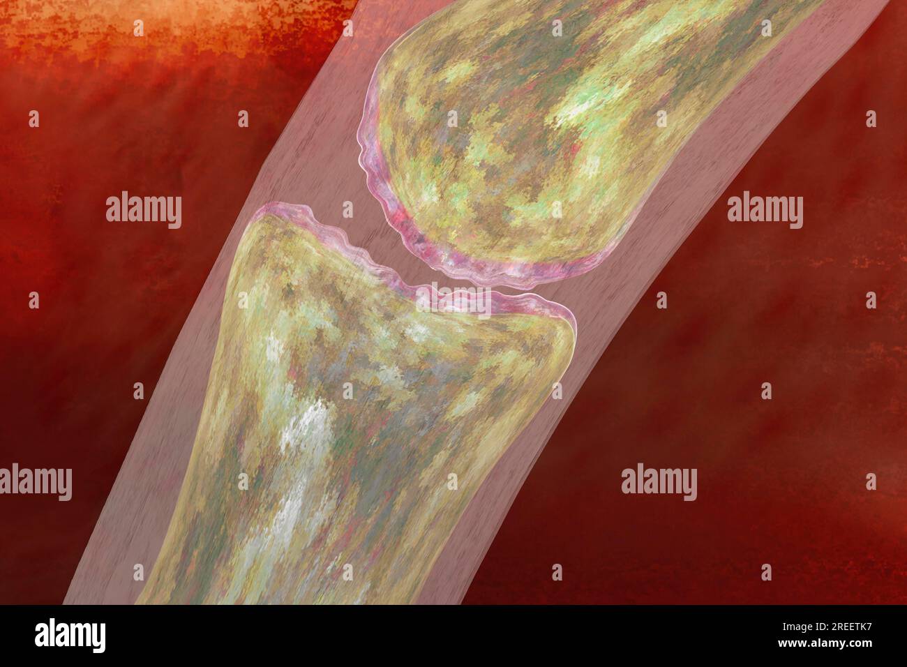 Joint inflammation is typical for rheumatism Stock Photo - Alamy