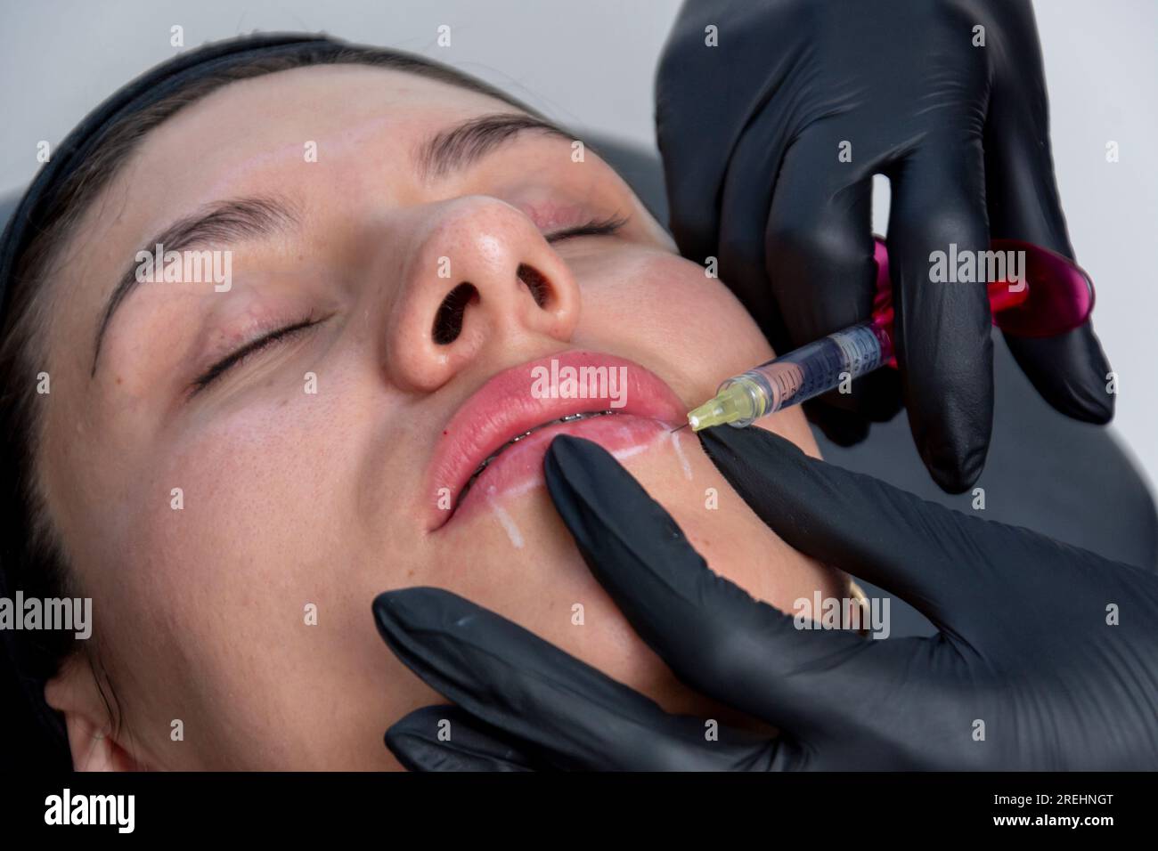 Close up of the lips of a young woman who is having a hyaluronic acid ...