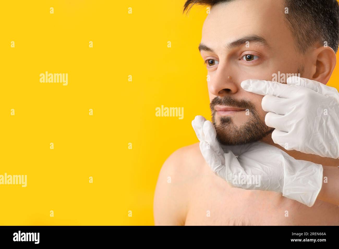 Skin cancer mole face woman hi-res stock photography and images - Alamy