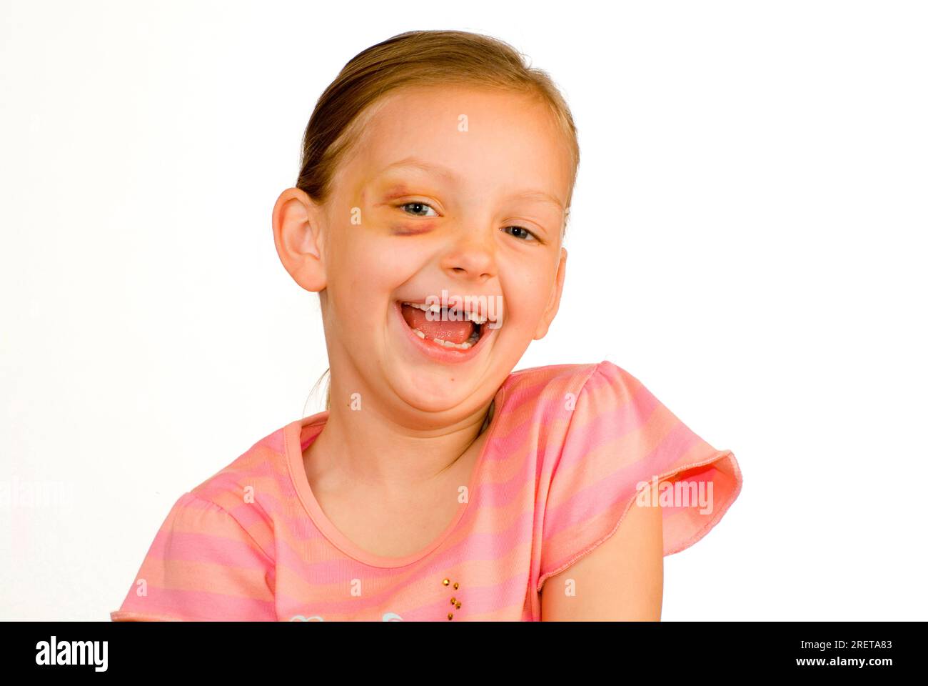 People Missing An Eye