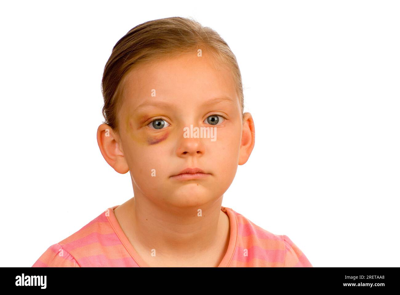 Girl with injury, black eye, hematoma, bruise, child abuse Stock Photo ...