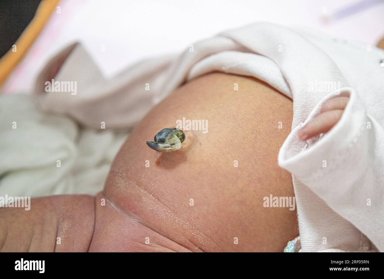 newborn navel after cutting the umbilical cord Stock Photo - Alamy