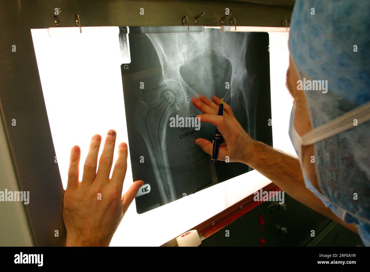 A medical professional examining a hip joint X-ray using a lightbox in ...
