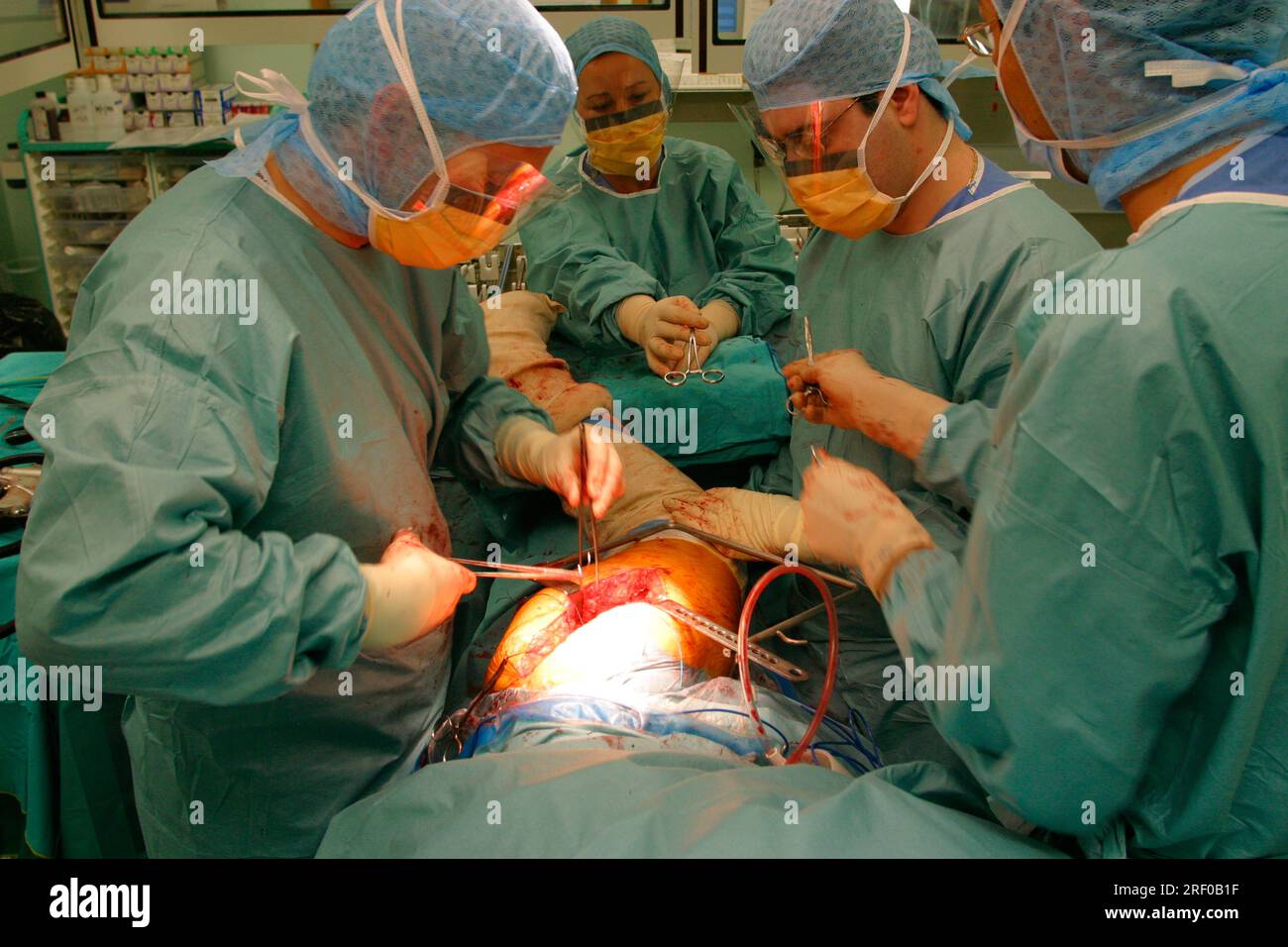 Medical team performing hip replacement surgery in a hospital operating ...