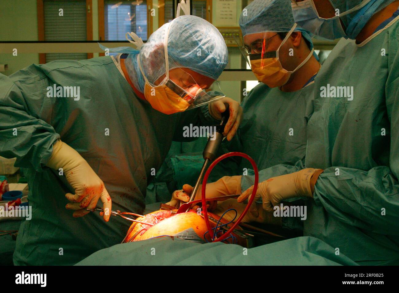 Medical team performing hip replacement surgery in a hospital operating ...