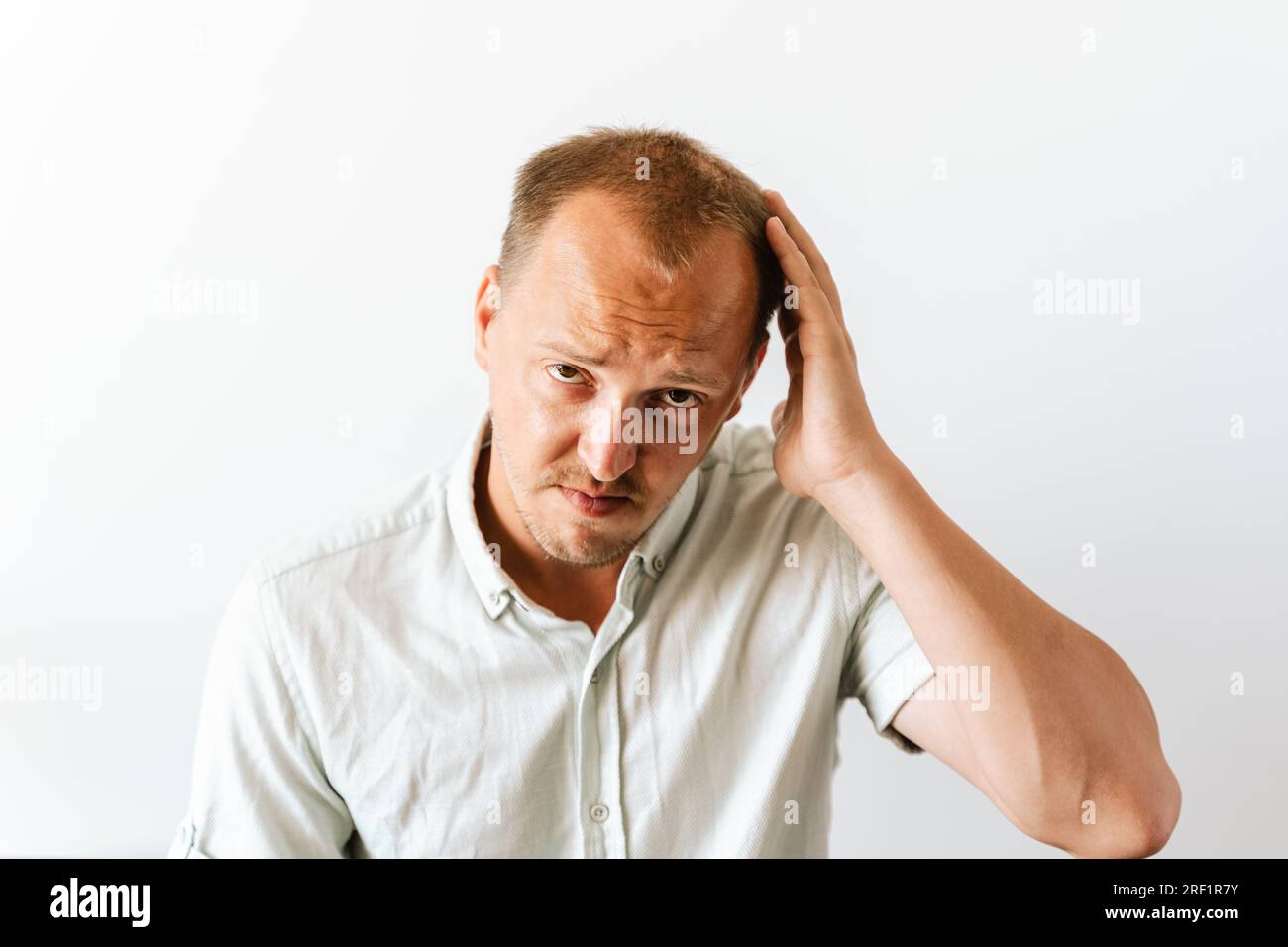 Young sad bald man with depression at hair loss problems looking angry ...