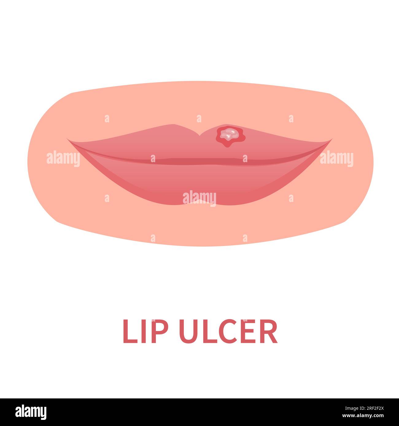 Lip Ulcer Oral Disease Icon Lips Inflammation Irritation And Ulceration With Cracked And